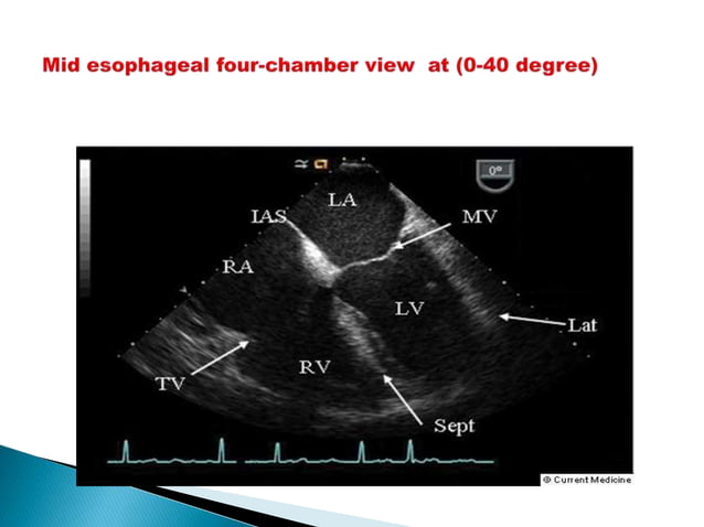Transesophageal echocardiography(TEE) | PPTX