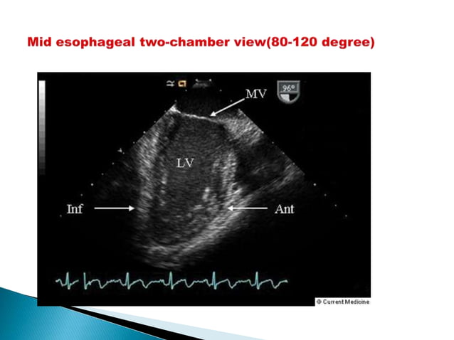 Transesophageal echocardiography(TEE) | PPTX