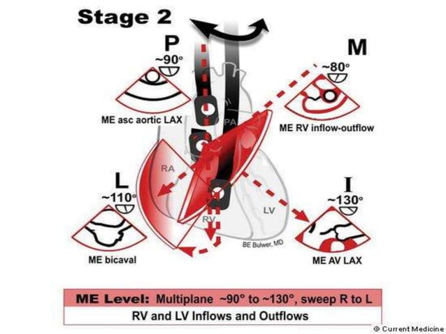 Transesophageal echocardiography(TEE) | PPTX