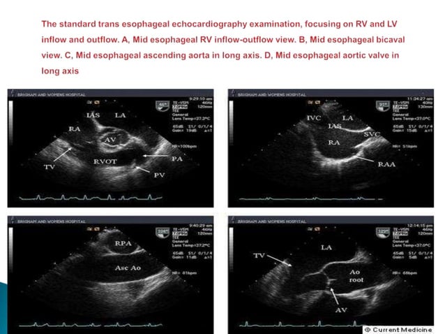Transesophageal echocardiography(TEE) | PPTX