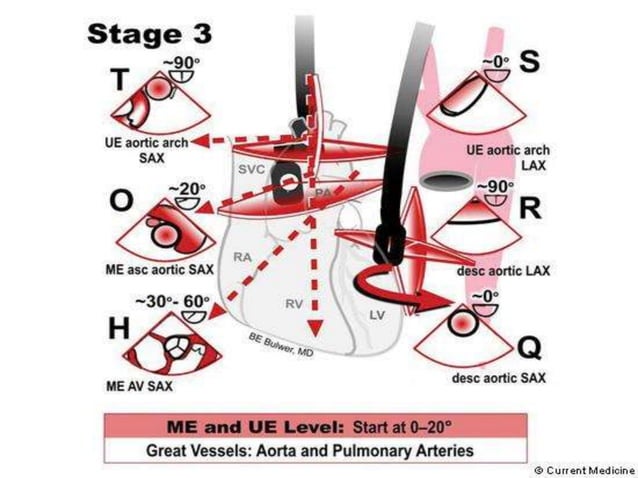 Transesophageal echocardiography(TEE) | PPTX