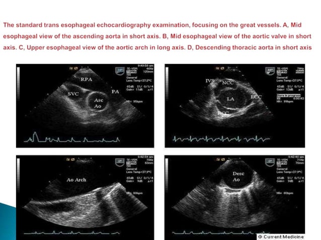 Transesophageal echocardiography(TEE) | PPTX