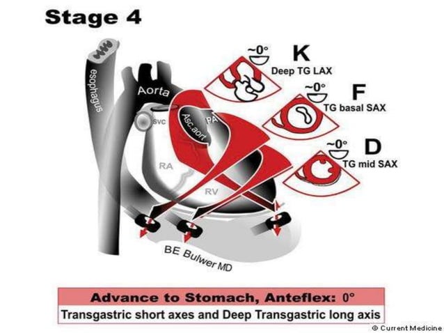 Transesophageal echocardiography(TEE) | PPTX