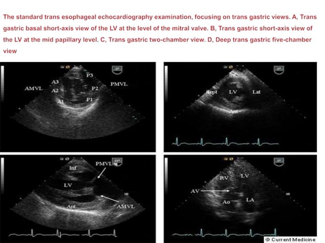 Transesophageal echocardiography(TEE) | PPTX
