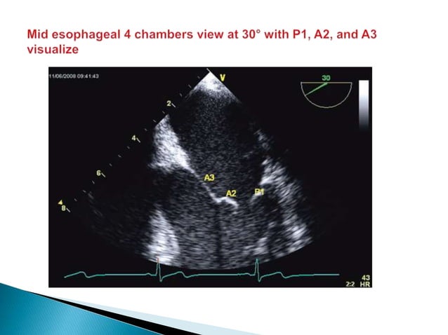 Transesophageal echocardiography(TEE) | PPTX