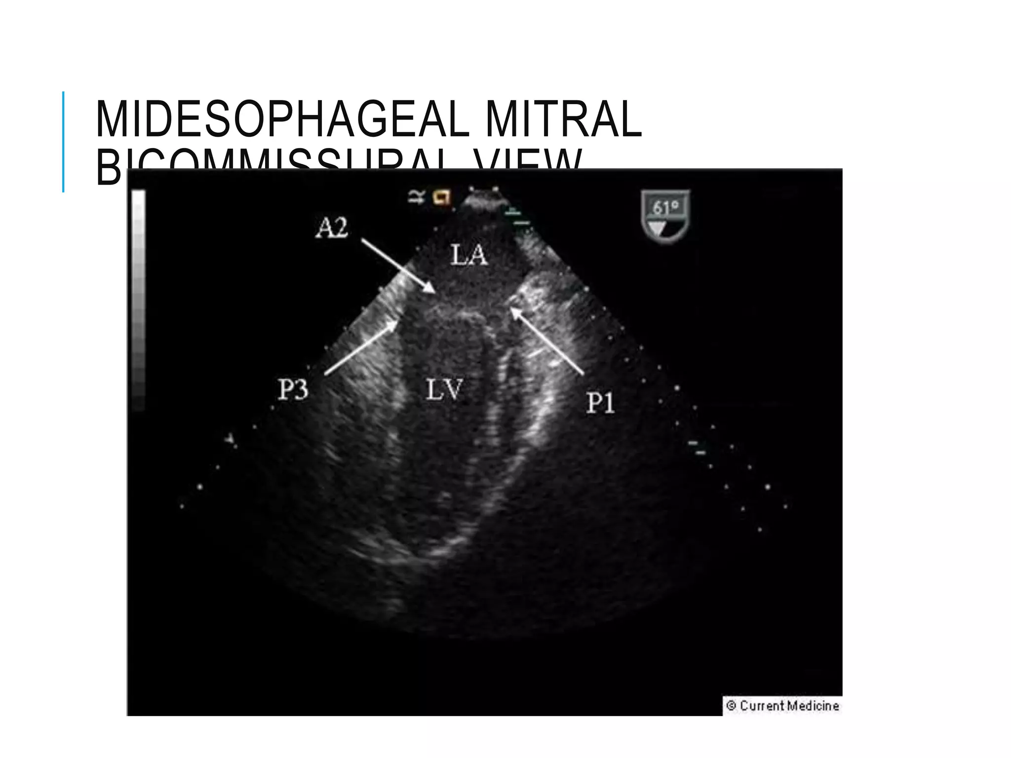 TRANSESOPHAGEAL ECHOCARDIOGRAPHY.pptx