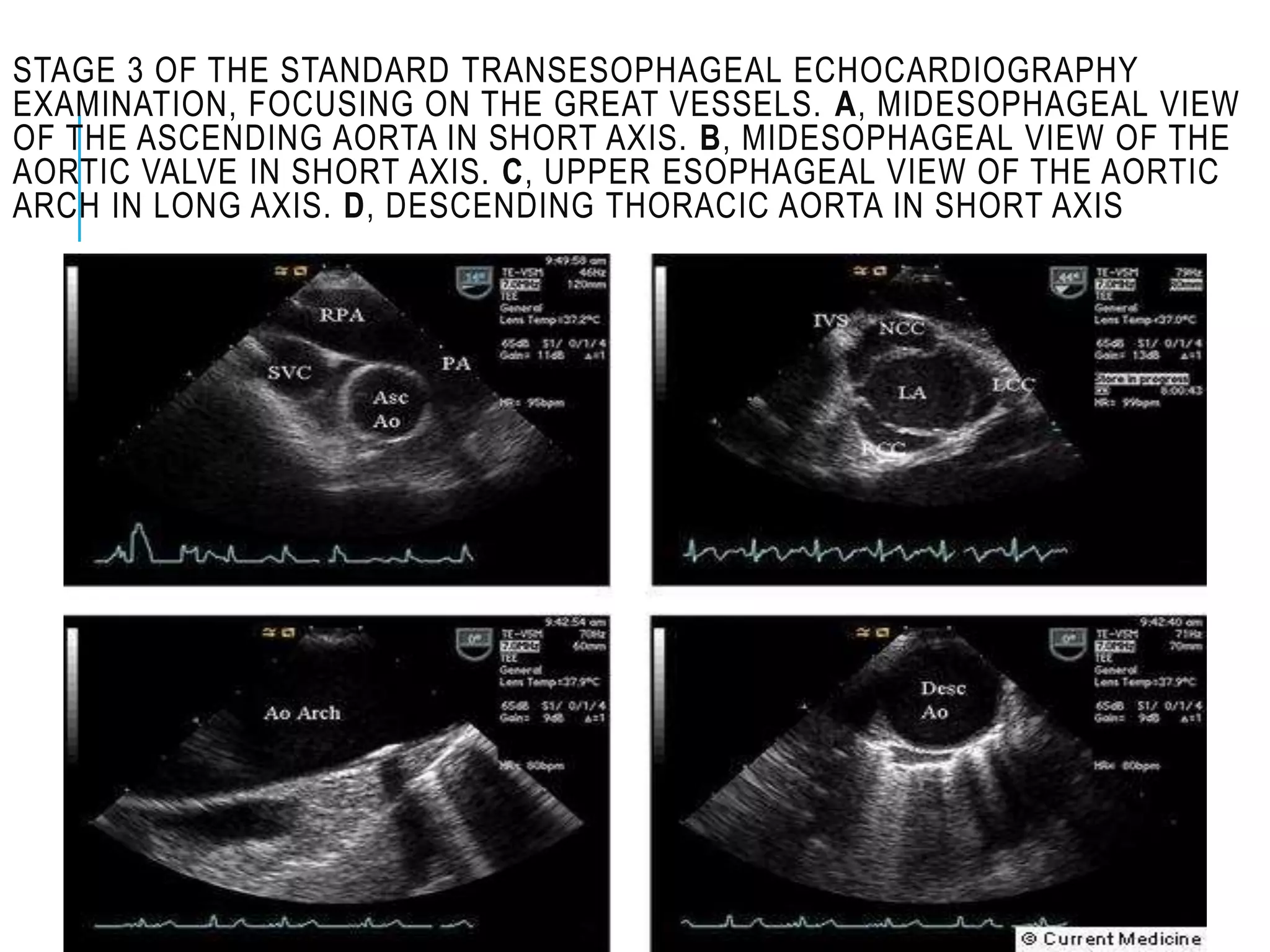 TRANSESOPHAGEAL ECHOCARDIOGRAPHY.pptx
