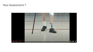 TRANSFEMORAL GAIT DEVIATIONS with causes and managment | PPTX