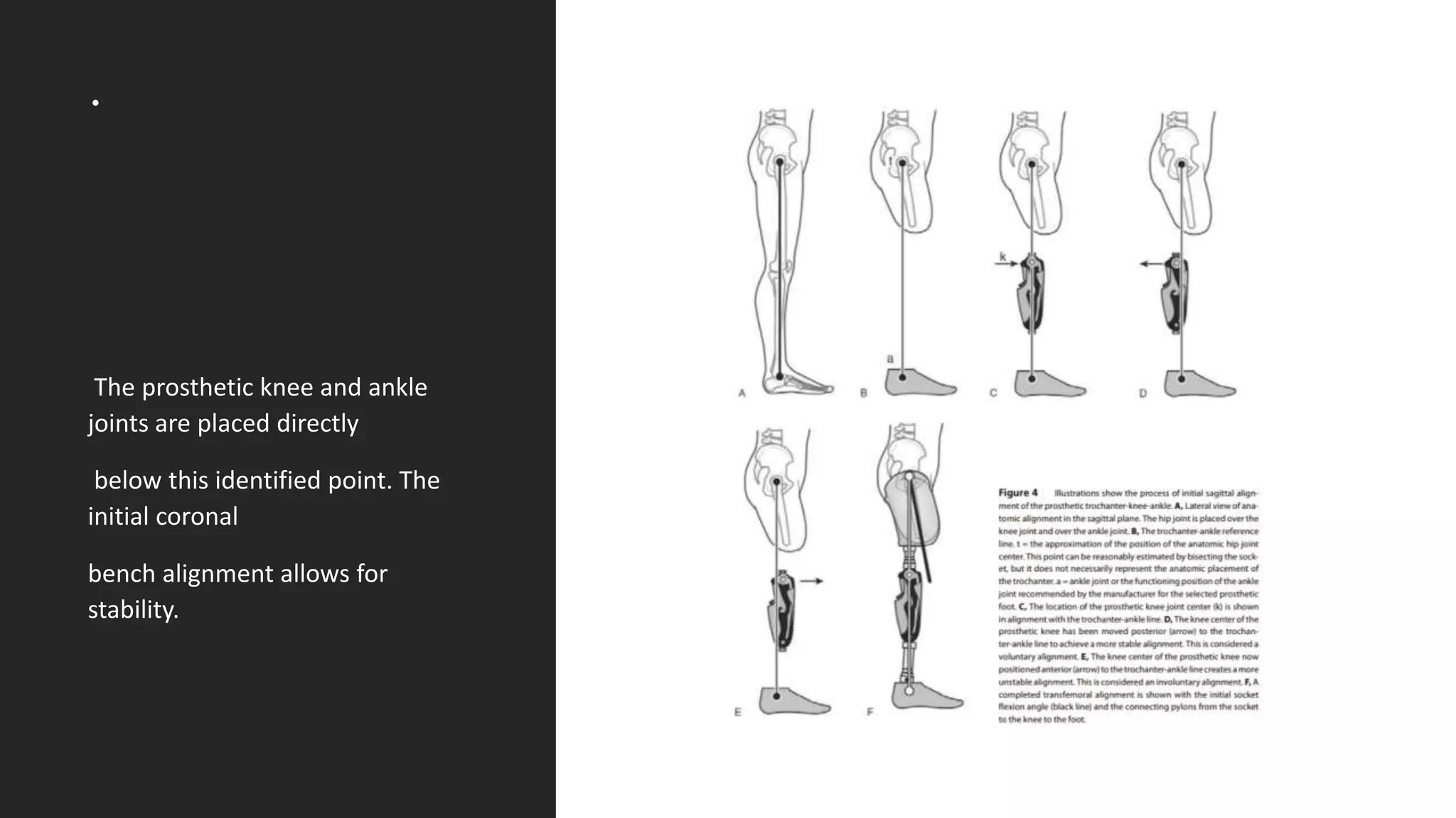 Transfemoral prosthesis alignment (prosthetics science) | PPTX