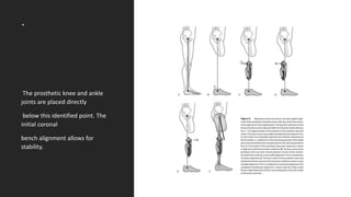 Transfemoral prosthesis alignment (prosthetics science) | PPTX