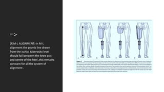 Transfemoral prosthesis alignment (prosthetics science) | PPTX