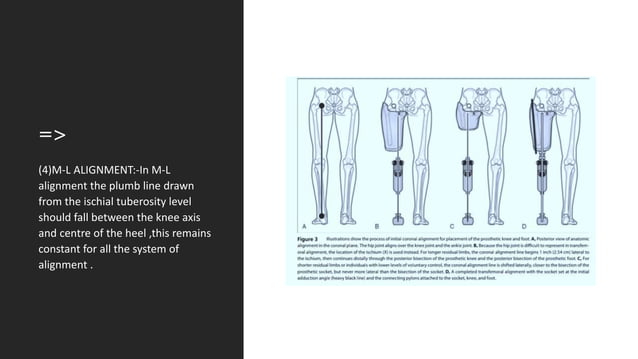 Transfemoral prosthesis alignment (prosthetics science) | PPTX