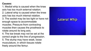 Transfemoral Prosthesis Gait Deviations.pptx