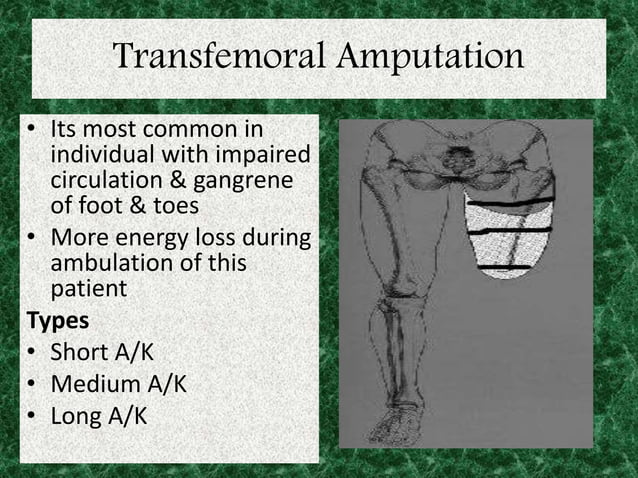 Transfemoral protheses | PPTX