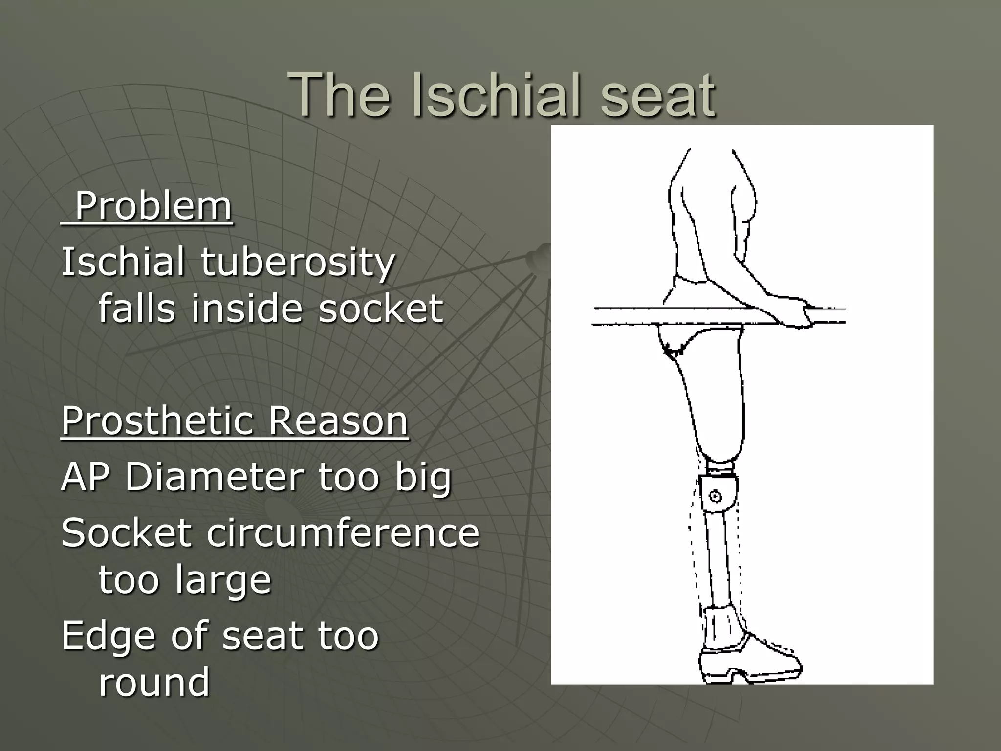 Transfemoral Socket Problems.ppt