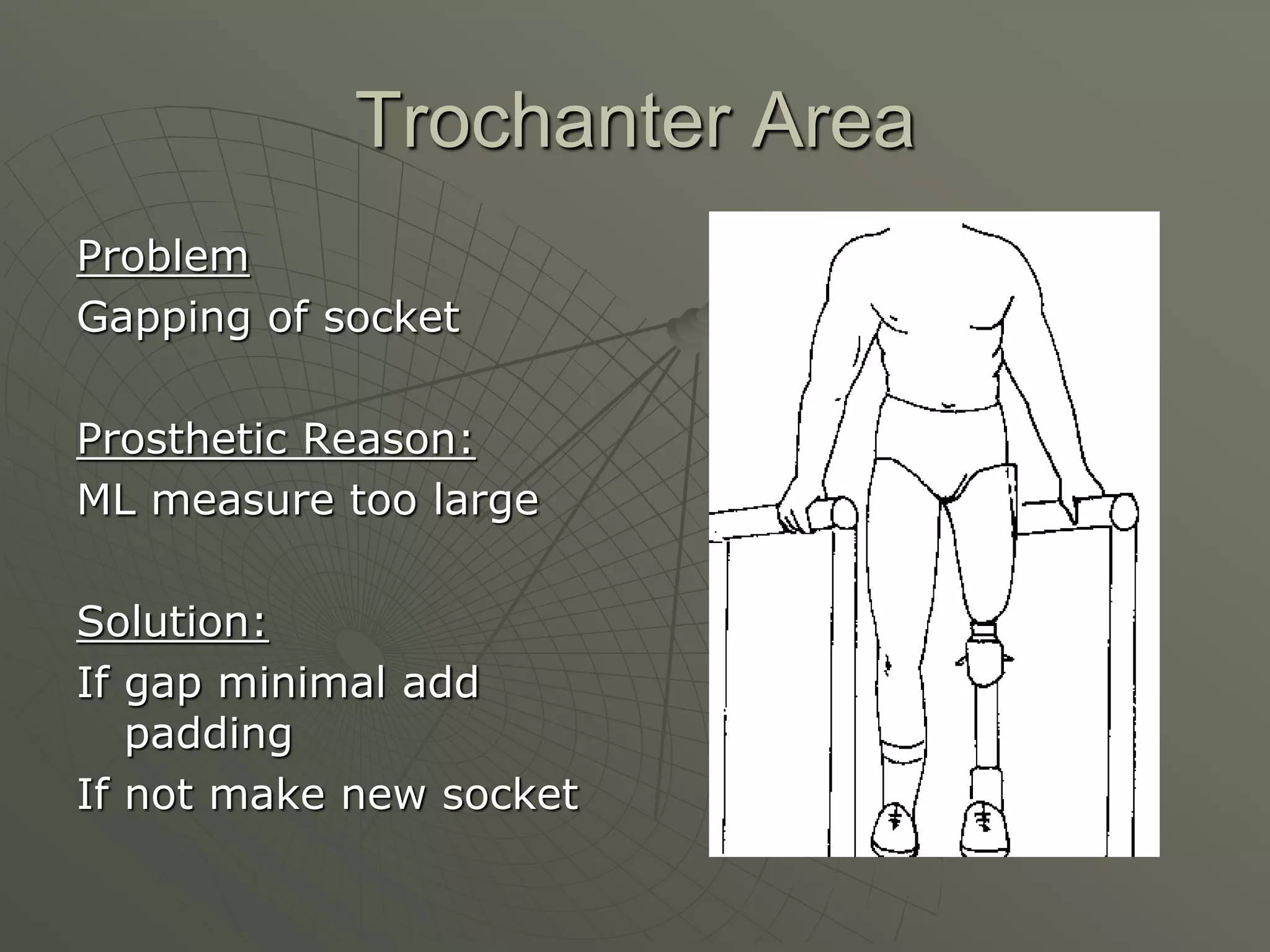 Transfemoral Socket Problems.ppt
