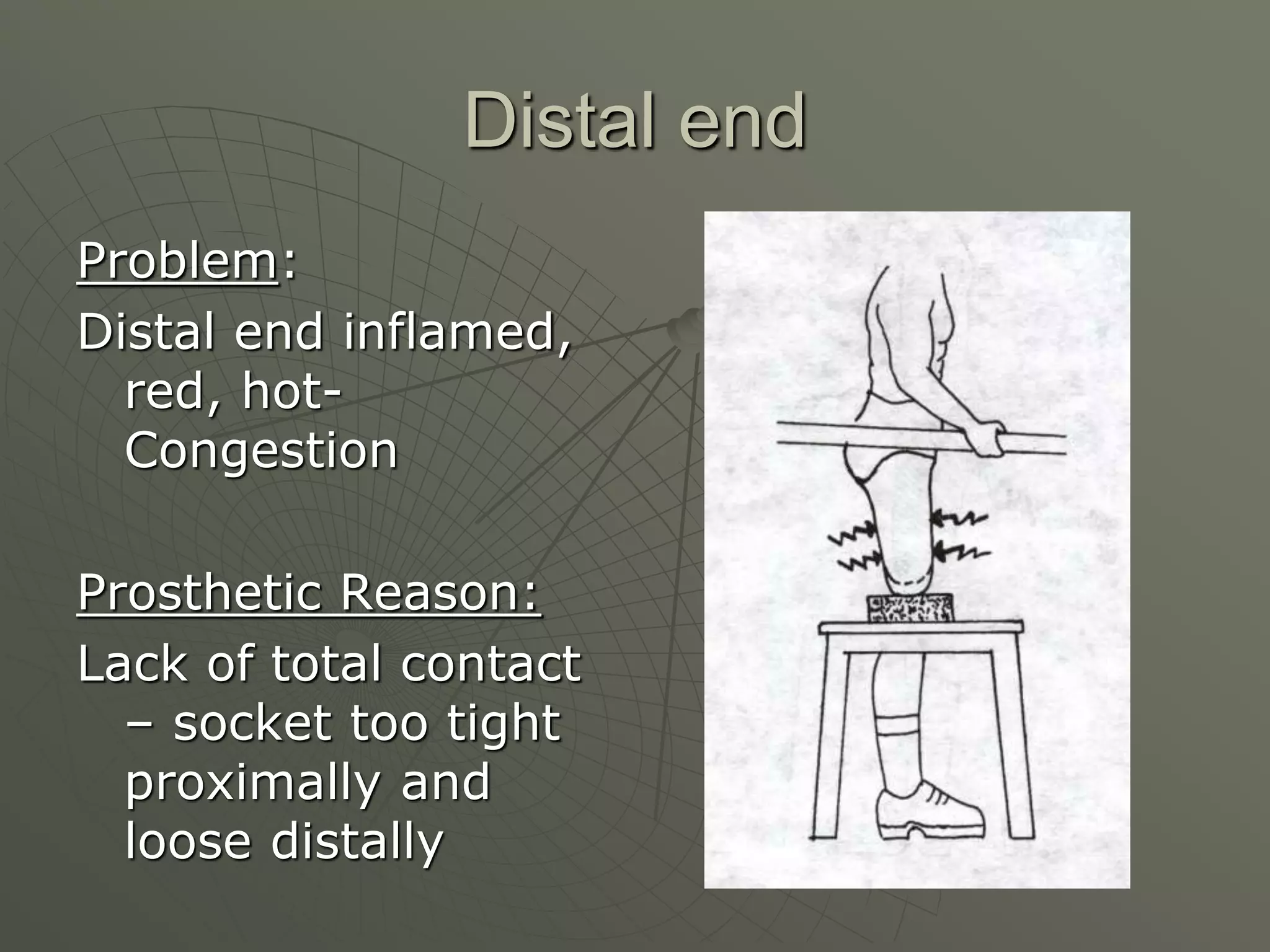 Transfemoral Socket Problems.ppt