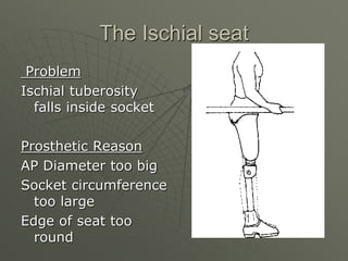 Transfemoral Socket Problems.ppt
