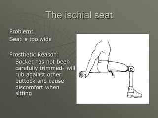 Transfemoral Socket Problems.ppt