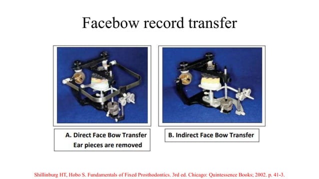 Transferring records on articulator and programming | PPTX | Dental ...