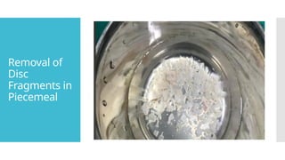 TRANSFORAMINAL ENDOSCOPIC LUMBAR DISCECTOMY BY DR.RAJESH PULIPAKA.pptx