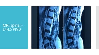 TRANSFORAMINAL ENDOSCOPIC LUMBAR DISCECTOMY BY DR.RAJESH PULIPAKA.pptx