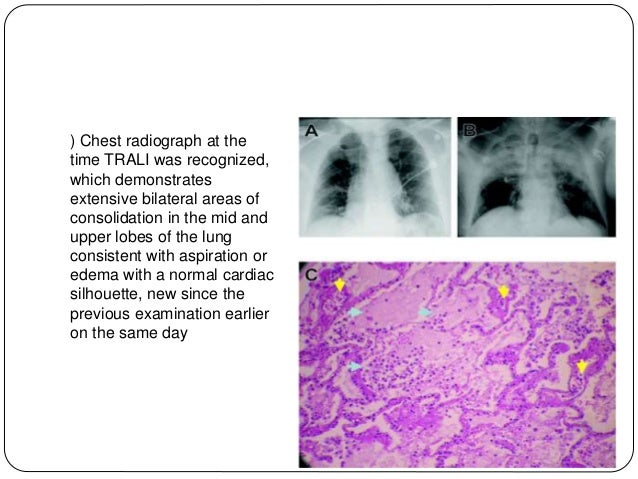 Transfusion related acute lung injury