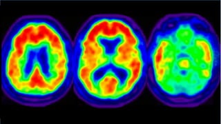 Transfusion Thresholds in Acute Brain Injury | PPT
