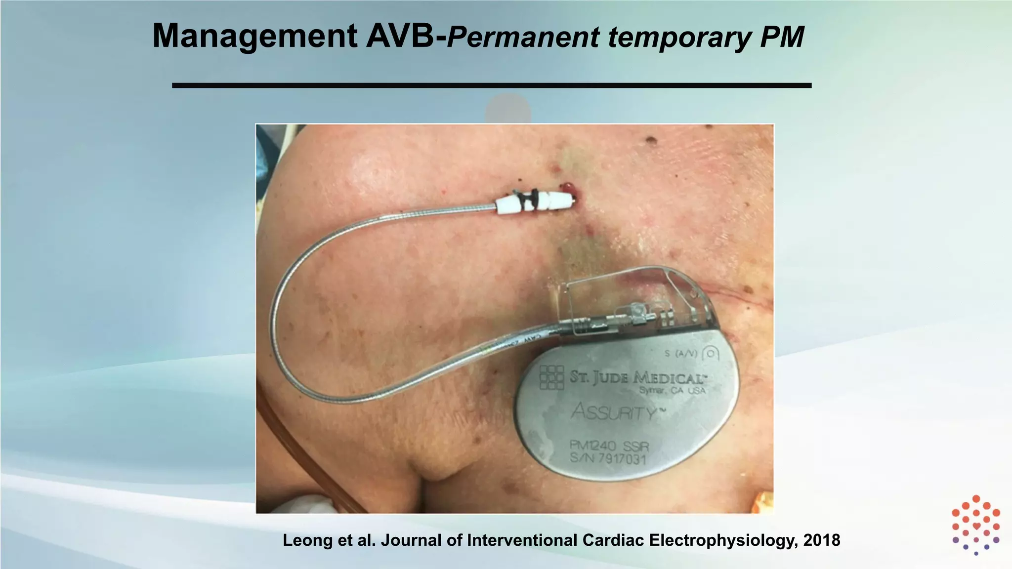 Fundación EPIC _ Transient atrioventricular block after TAVI, what to ...
