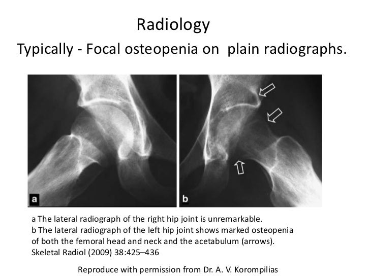 Transient Osteoporosis of Hip