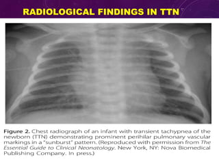 Transient tachypnea of newborn ttn | PPT