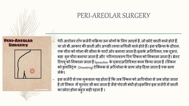 FTM Transition Top Surgery | PPT