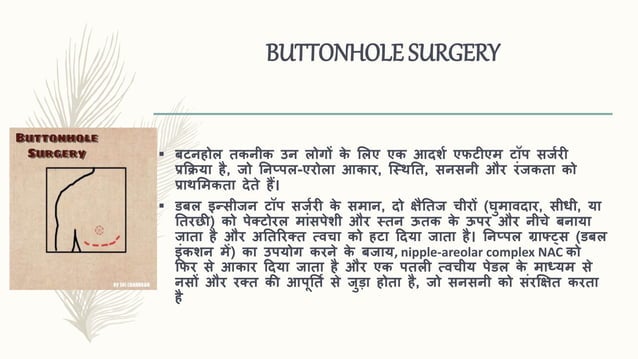 FTM Transition Top Surgery | PPT