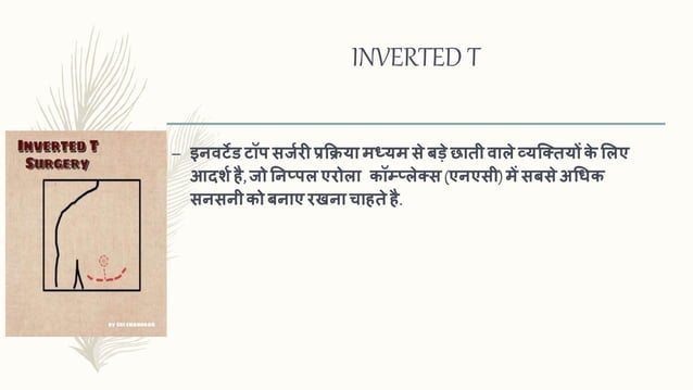 FTM Transition Top Surgery | PPT