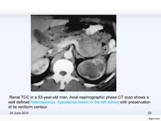 Transitional cell carcinoma | PPTX