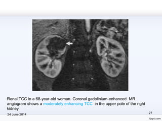 Transitional cell carcinoma | PPTX