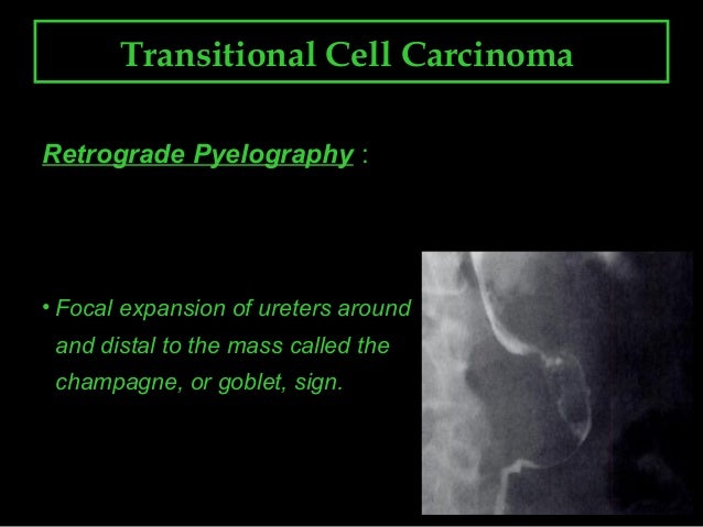 Transitional Cell Carcinoma