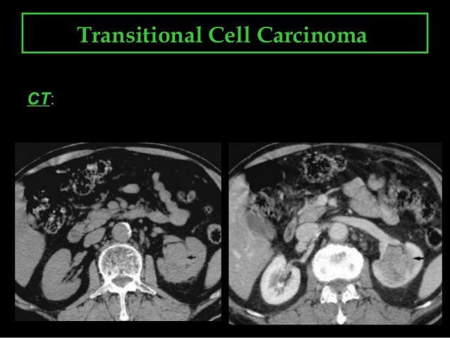 Transitional Cell Carcinoma