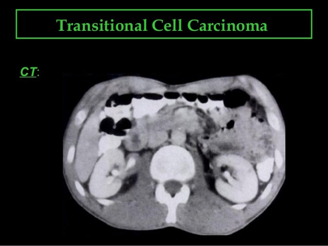 Transitional Cell Carcinoma