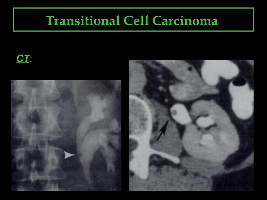 Transitional Cell Carcinoma