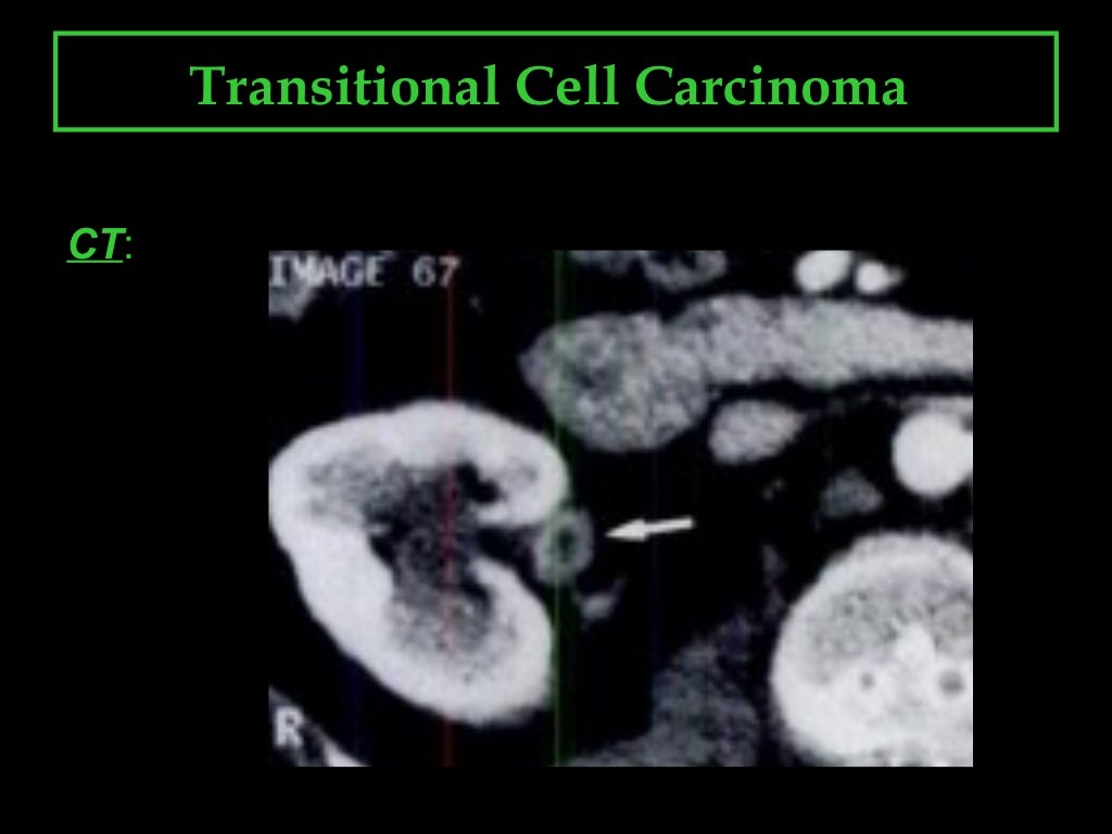 Transitional Cell Carcinoma