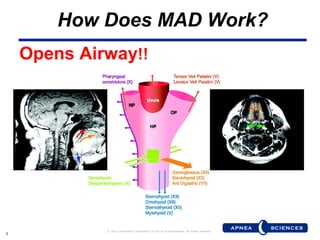 Transitional dental sleep apnea apnea rx training | PPT