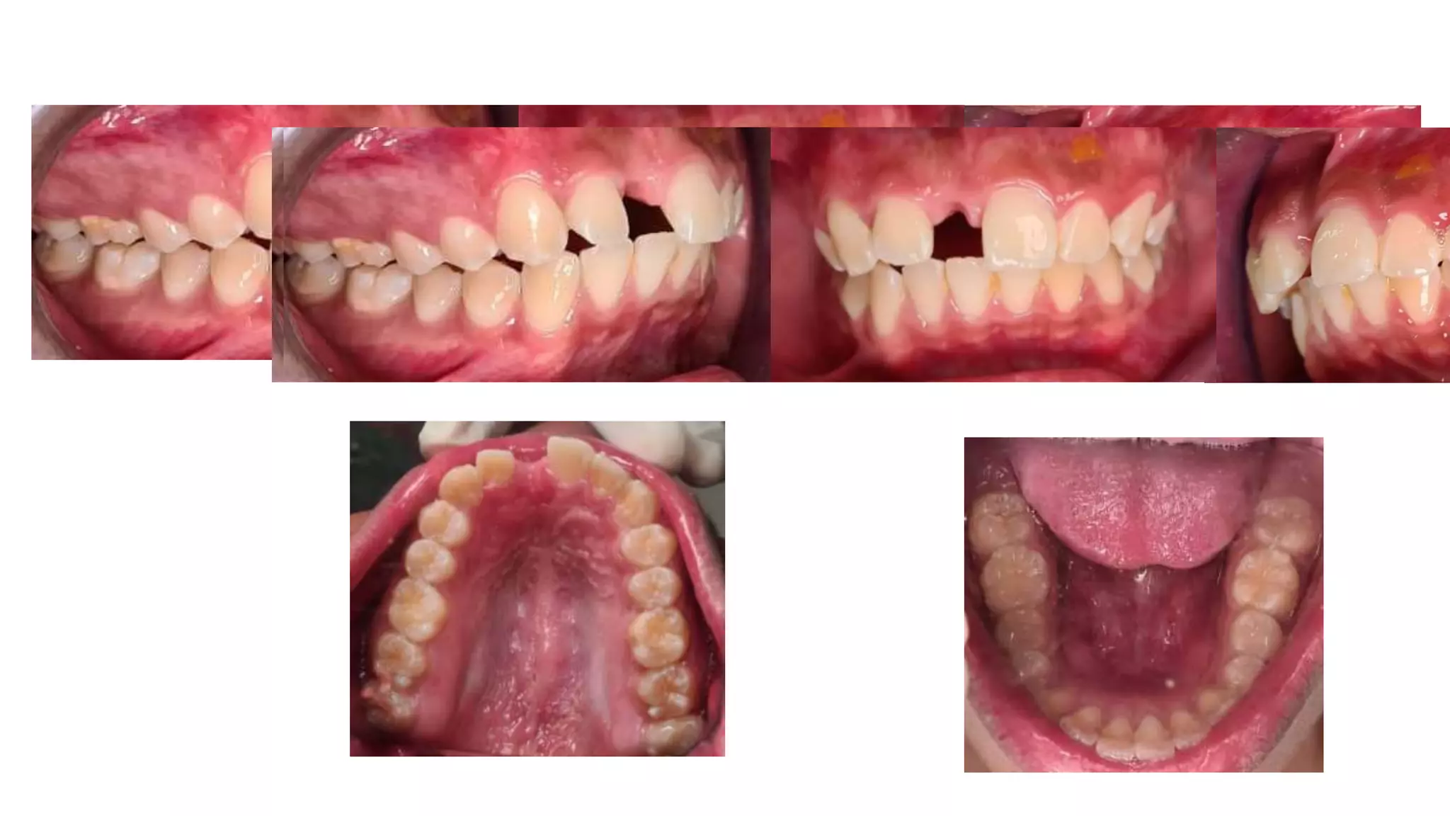 TRANSITIONAL DENTURE.pptx