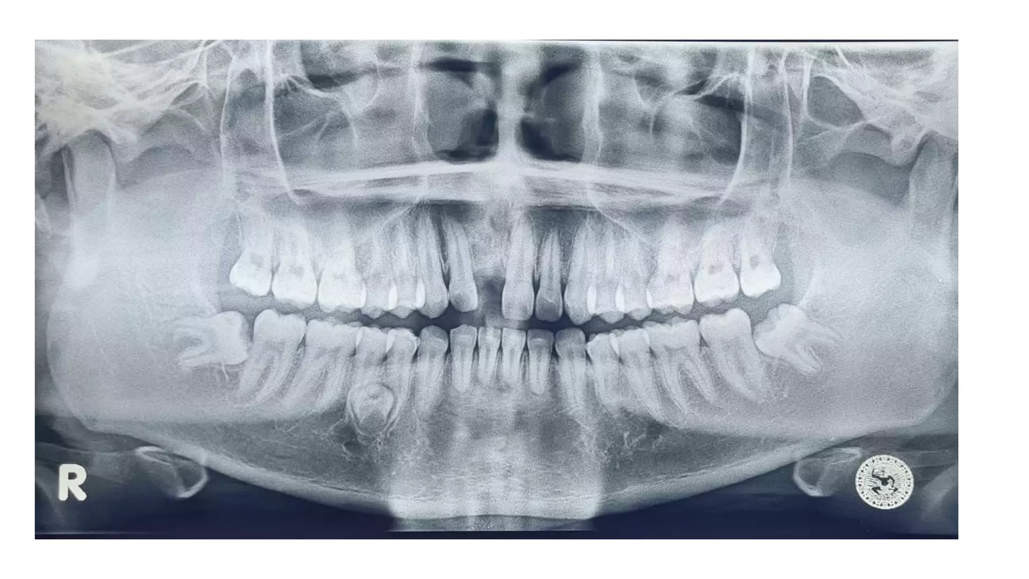 TRANSITIONAL DENTURE.pptx