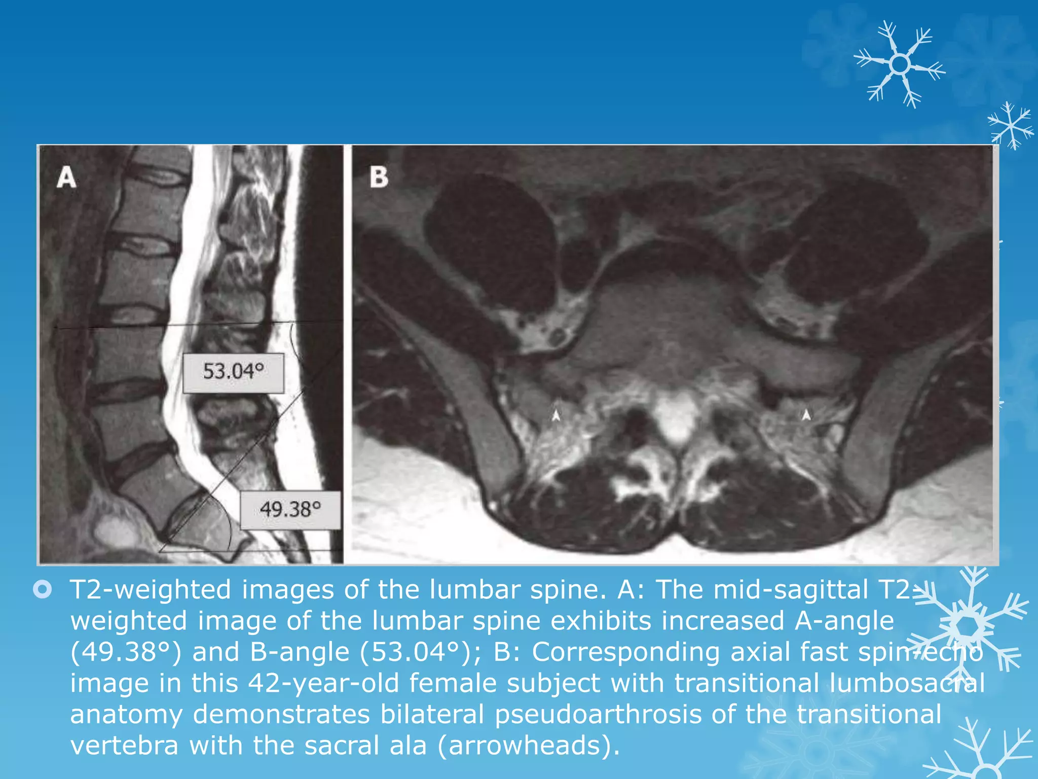 Transitional vertebrae | PPTX