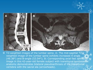 Transitional vertebrae | PPTX