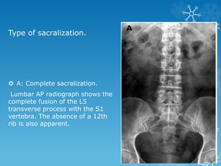 Transitional vertebrae | PPTX