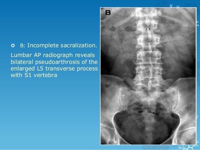 Transitional vertebrae