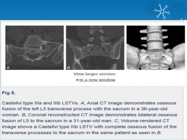 Transitional vertebrae