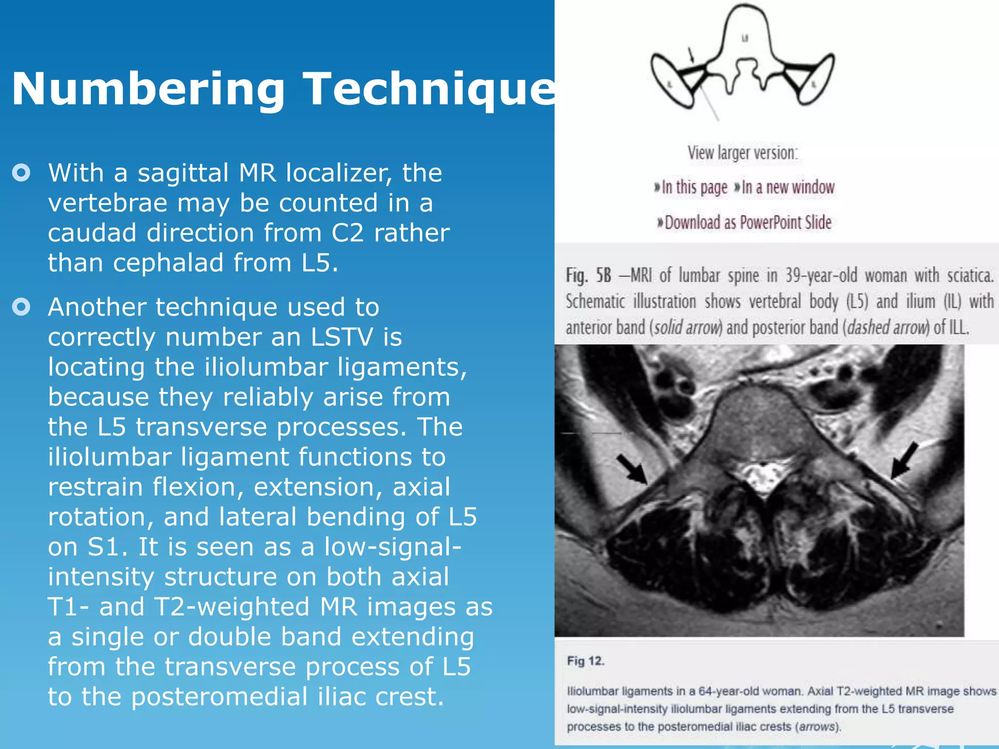 Transitional vertebrae radiology | PPTX